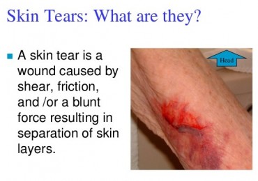 Skin Tear: una nuova frontiera da esplorare | Nurse Times