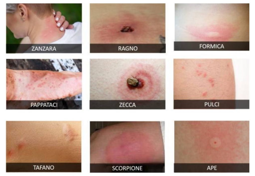 Punture da ape, zanzara, cimice e zecche: cosa fare e come distinguerle ...